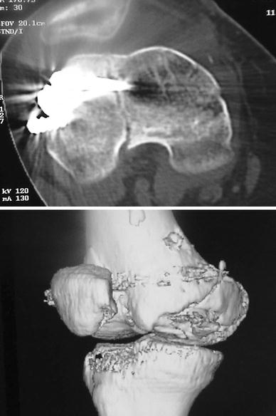Coronal fractures of the medial femoral condyle: a series of 6 cases ...