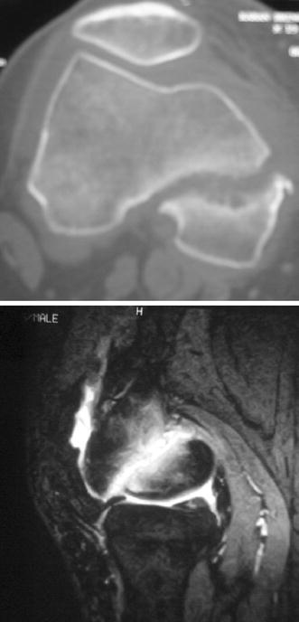 Coronal fractures of the medial femoral condyle: a series of 6 cases ...