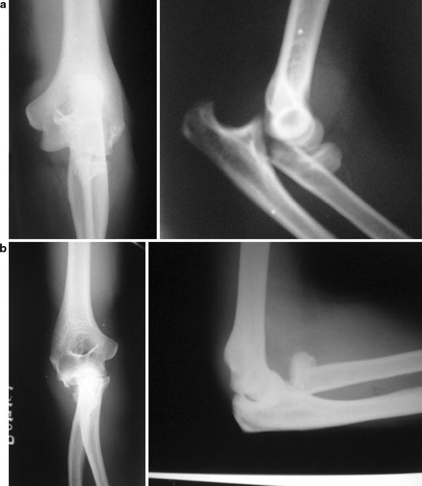 Heterotopic ossification of the elbow after closed reduction and ...