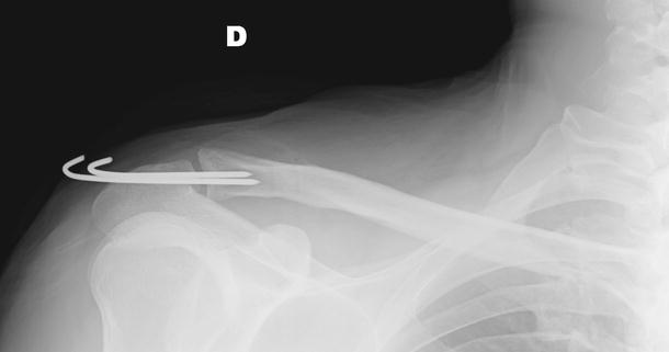 Modified Phemister procedure for the surgical treatment of Rockwood ...