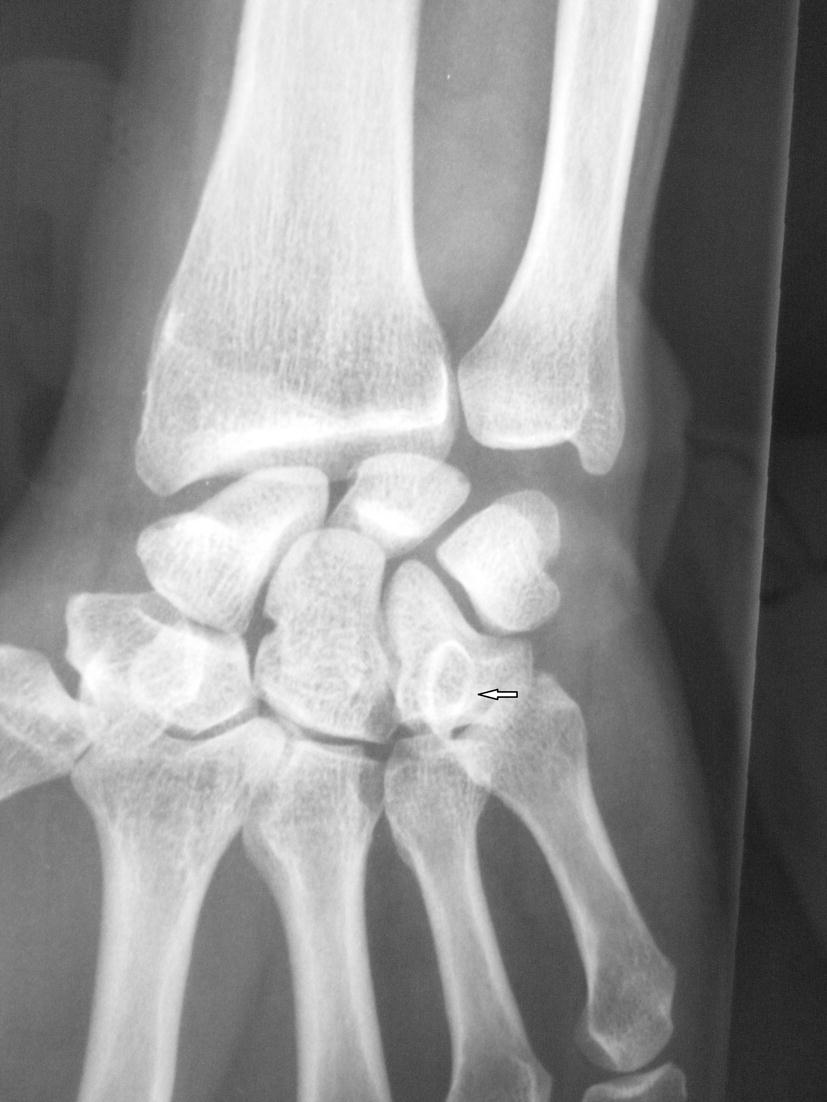 Fractures of hamate: a clinical overview | SpringerLink