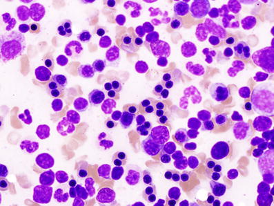 Congenital dyserythropoietic anemia type II (CDA II) diagnosed in an ...