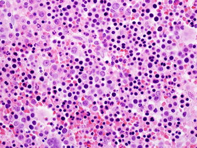 Congenital dyserythropoietic anemia type II (CDA II) diagnosed in an ...