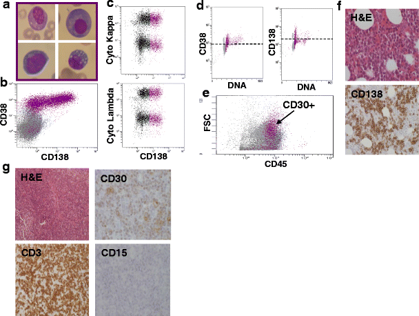 Flow cytometry detection of reactive plasmacytosis and HRS-like cells ...