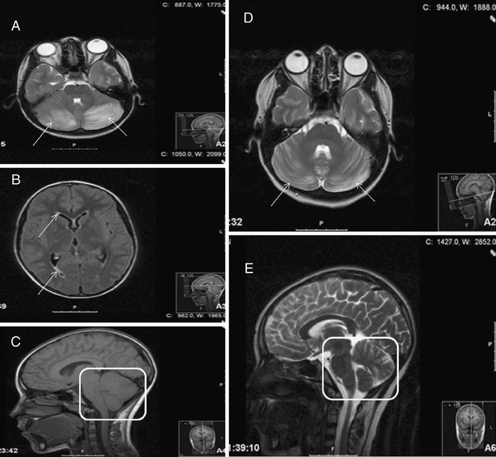 Acute Cerebellitis with Cerebellar Swelling Successfully Treated with ...