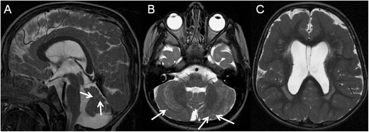 Cerebellar Cysts in Children: a Pattern Recognition Approach | SpringerLink