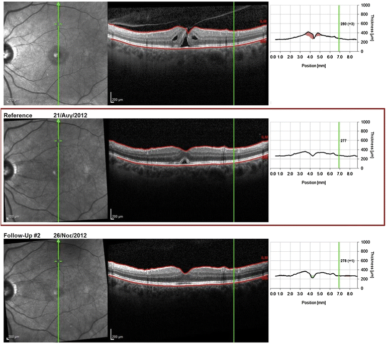 Persistent Subretinal Fluid After Successful Full-Thickness Macular ...