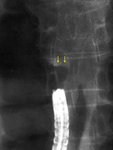 Transverse colonic varices successfully treated with endoscopic ...