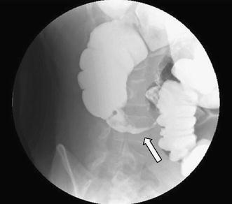 Multimodality imaging of cecal bascule: report of a case following ...