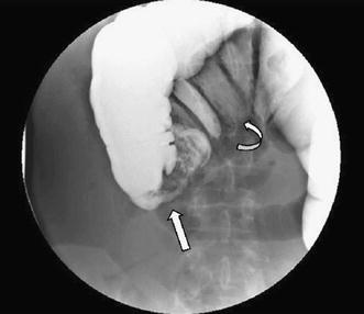 Multimodality imaging of cecal bascule: report of a case following ...