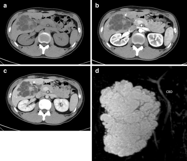 A variant of multicystic biliary hamartoma presenting as an ...
