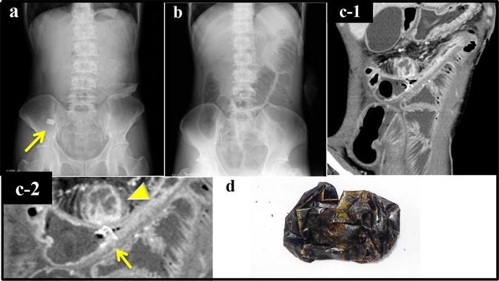 Retention of the cellophane wall of a patency capsule by intestinal ...