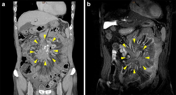 A case of protein-losing enteropathy caused by sclerosing mesenteritis ...