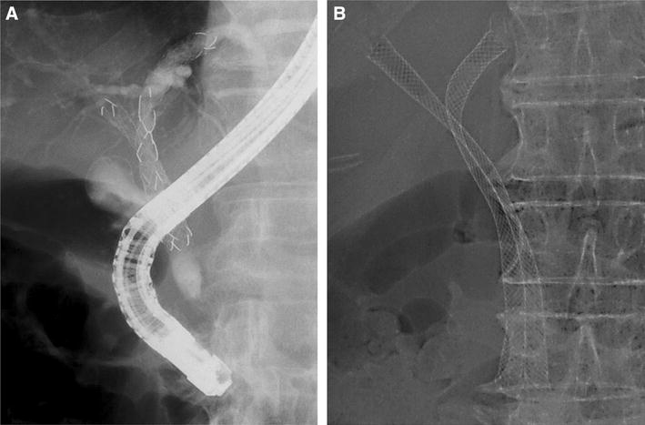 Endoscopic biliary stenting for unresectable malignant hilar ...