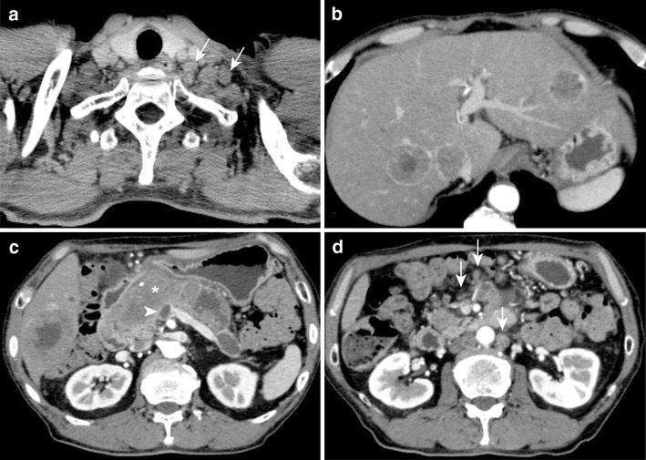 Successful chemotherapy with modified FOLFIRINOX for pancreatic acinar ...