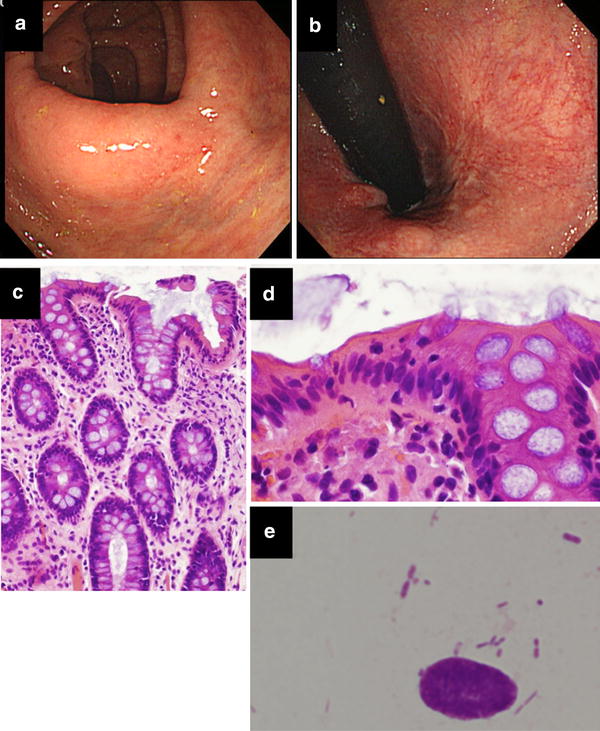Human intestinal spirochetosis mimicking ulcerative colitis | SpringerLink