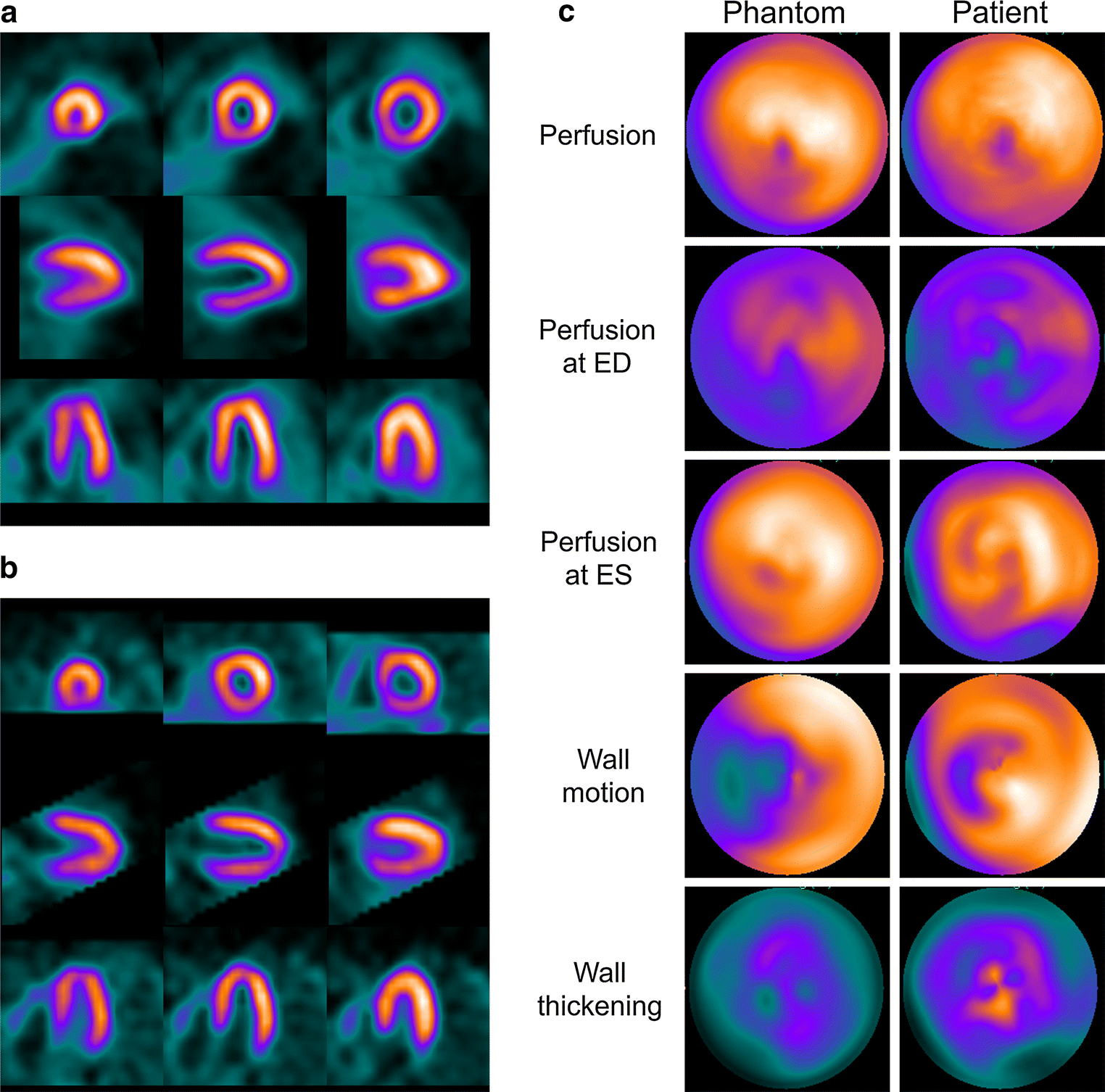 Has the era of dual-gated myocardial perfusion SPECT and PET arrived ...