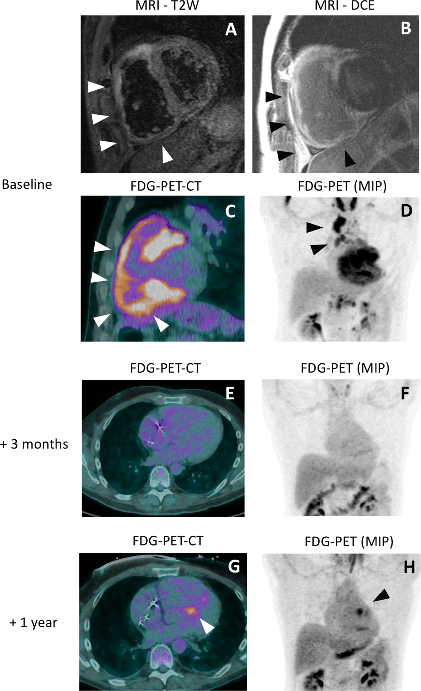 Imaging cardiac sarcoidosis with FDG-PET: Take a look at the right side ...