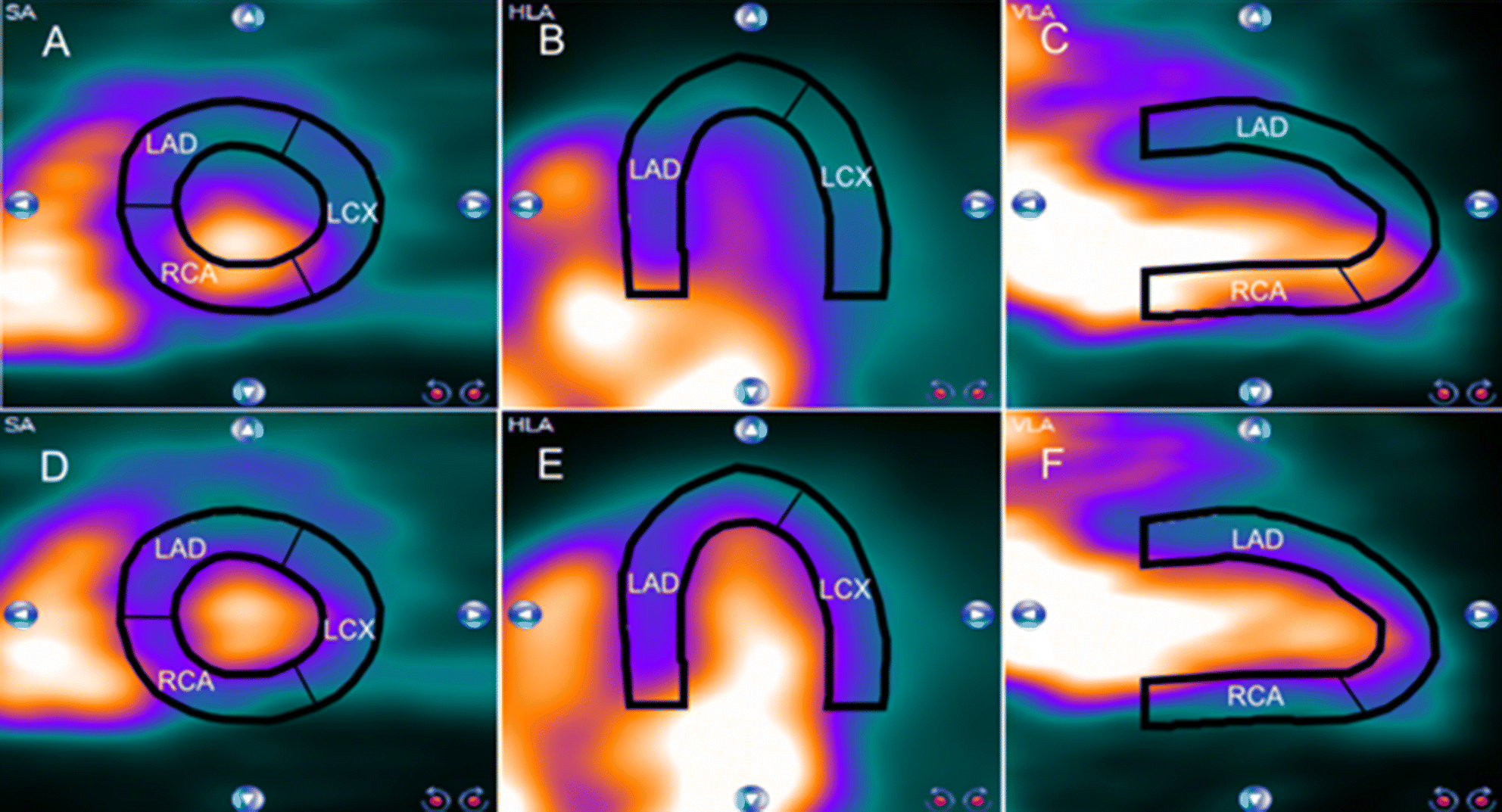 How to detect and correct myocardial creep in myocardial perfusion ...