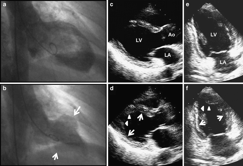 Stress-Induced Cardiomyopathy | SpringerLink