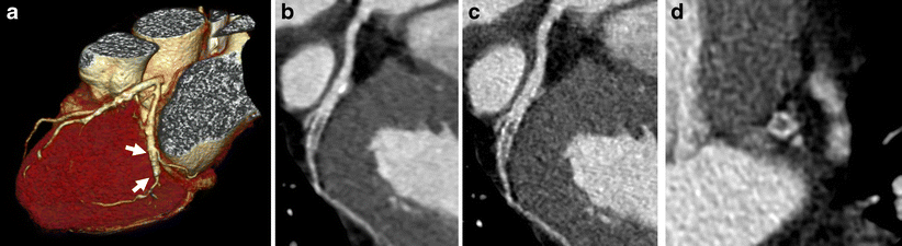 Imaging of Coronary Stents by Coronary CT-Angiography: Current Status ...