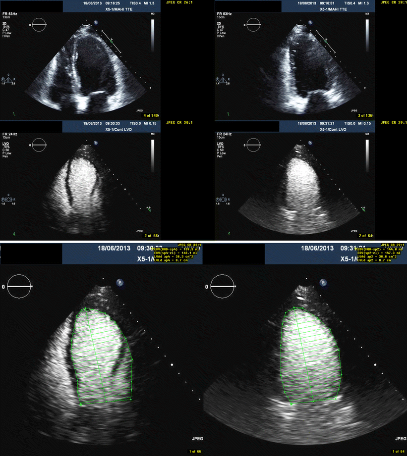 Contrast Echocardiography: Current Applications and Future Perspectives ...