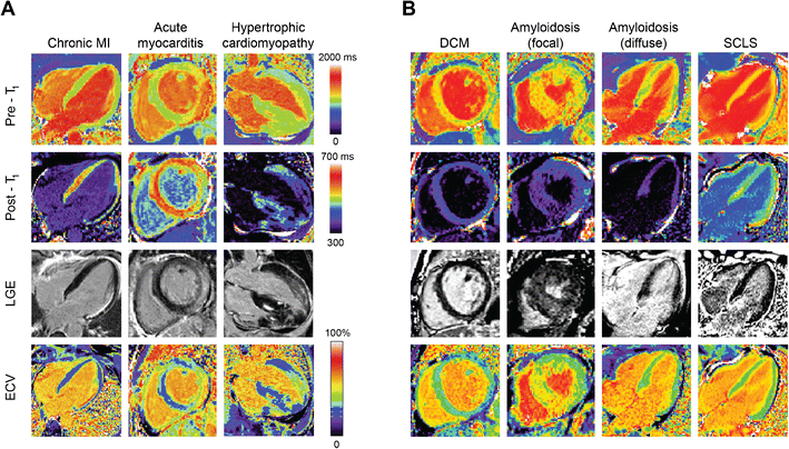 Contrast-Enhanced T1-Mapping MRI for the Assessment of Myocardial Fibrosis | SpringerLink