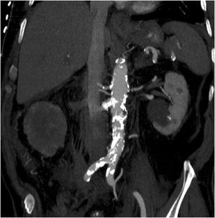 Transcaval TAVR—What the Radiologist Needs to Know | SpringerLink