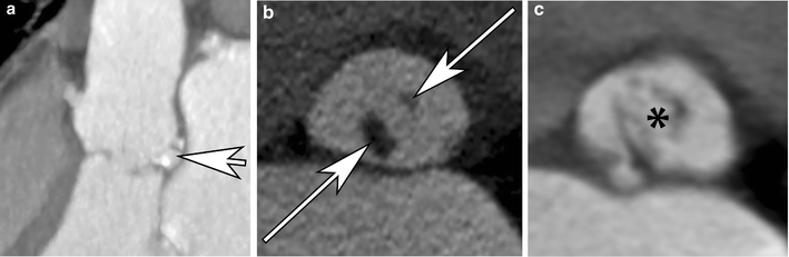 The Role of Cardiac CT in the Evaluation of Endocarditis | SpringerLink