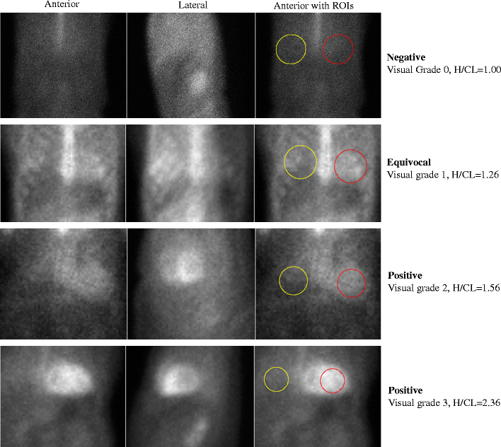 Imaging Options in Cardiac Amyloidosis: Differentiating AL from ATTR ...