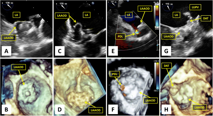Percutaneous Left Atrial Appendage Closure Devices | SpringerLink