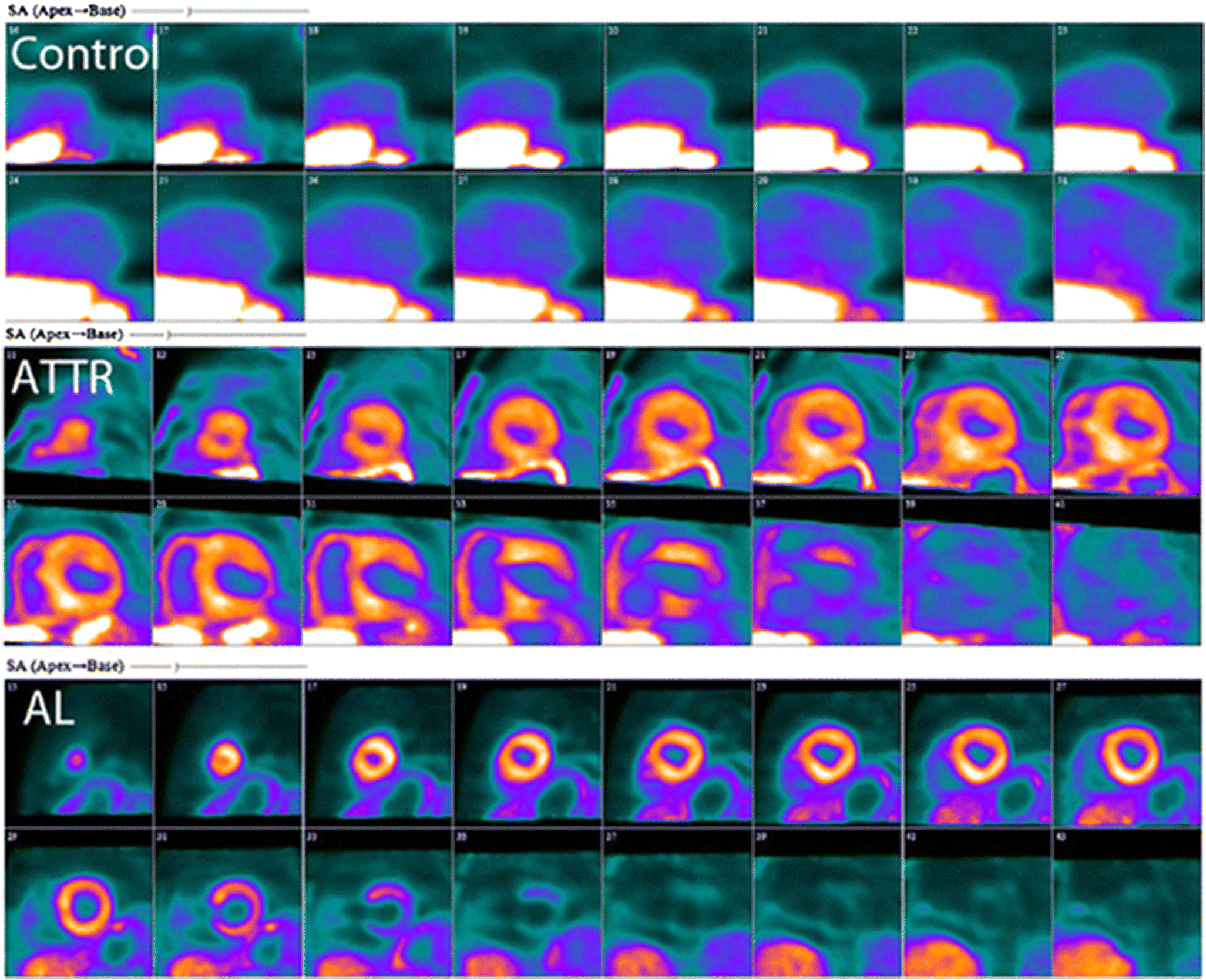 Molecular Imaging of Cardiac Amyloidosis | SpringerLink