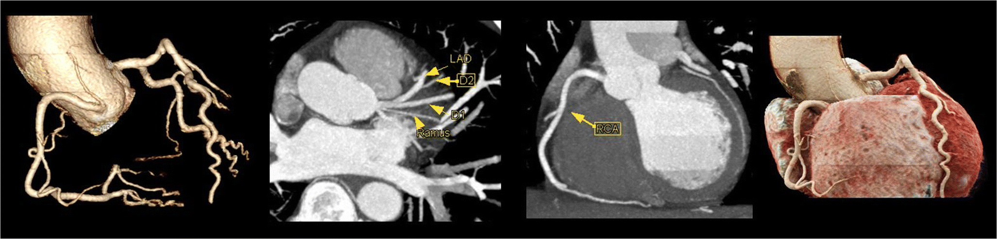 Cardiac CT: Technological Advances in Hardware, Software, and Machine ...