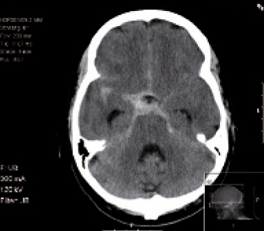SAB met ecg-afwijkingen | SpringerLink