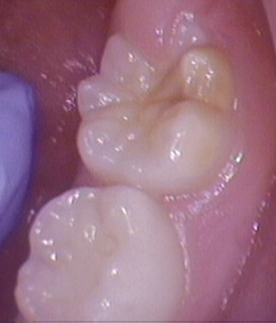 Kaaskiezen in het melkgebit en blijvende gebit | SpringerLink