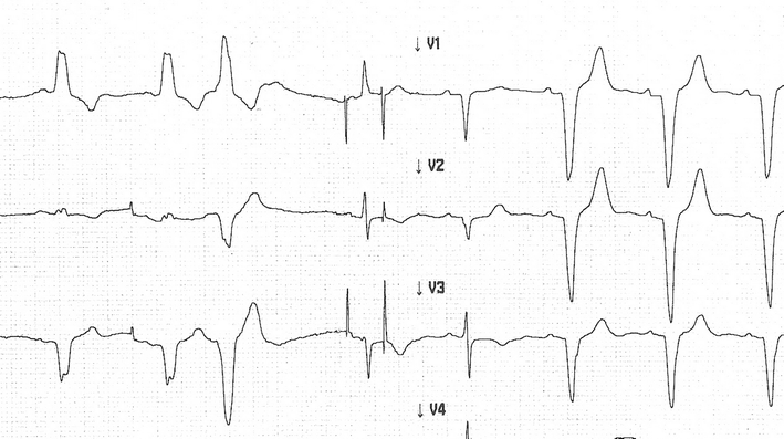 An unexpected finding in a patient with a DDDR pacemaker | SpringerLink