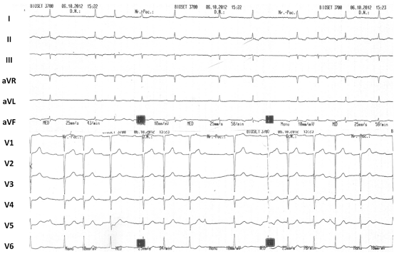 A Regularly Irregular Rhythm what Is The Diagnosis SpringerLink a-regularly-irregular-rhythm-what-is-the-diagnosis-springerlink