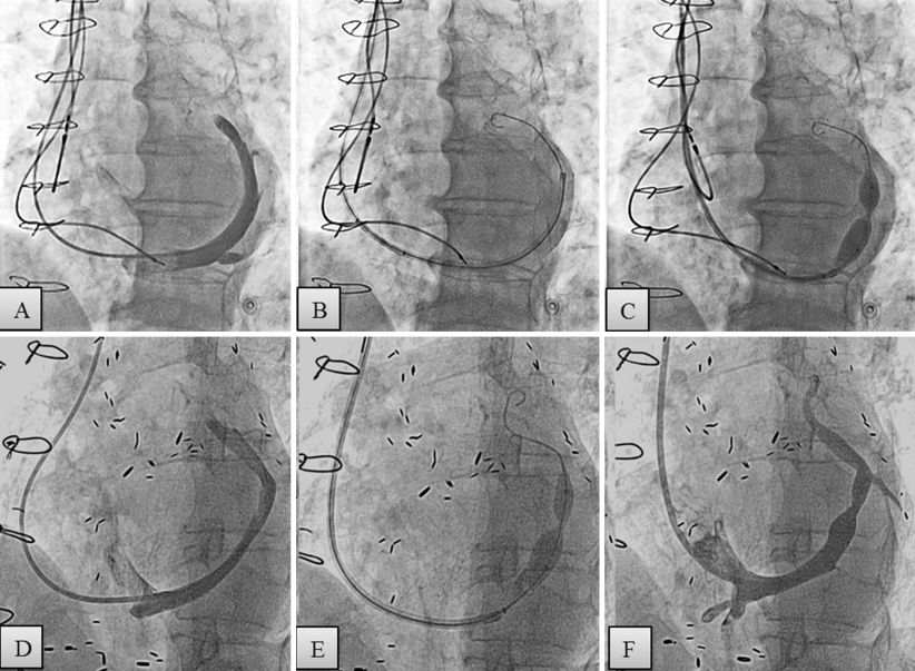 Safety and efficacy of a device to narrow the coronary sinus for the ...