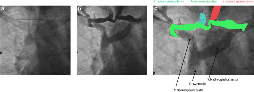 Enlarged jugular veins | SpringerLink