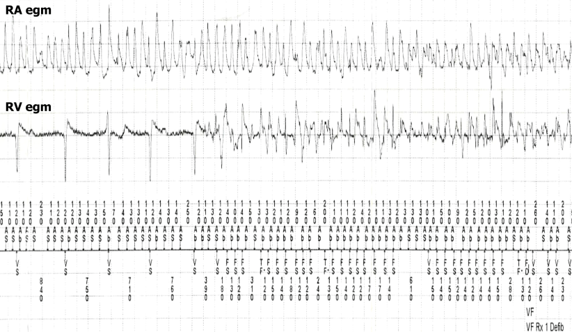 Appropriate or inappropriate ICD shock; what is the post-shock rhythm ...
