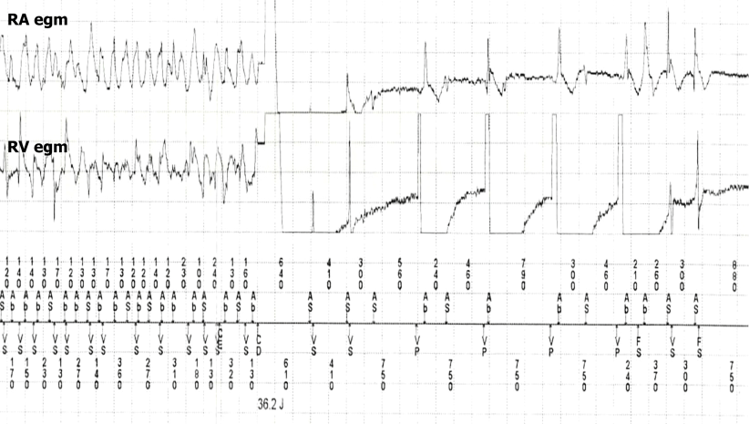 Appropriate or inappropriate ICD shock; what is the post-shock rhythm ...