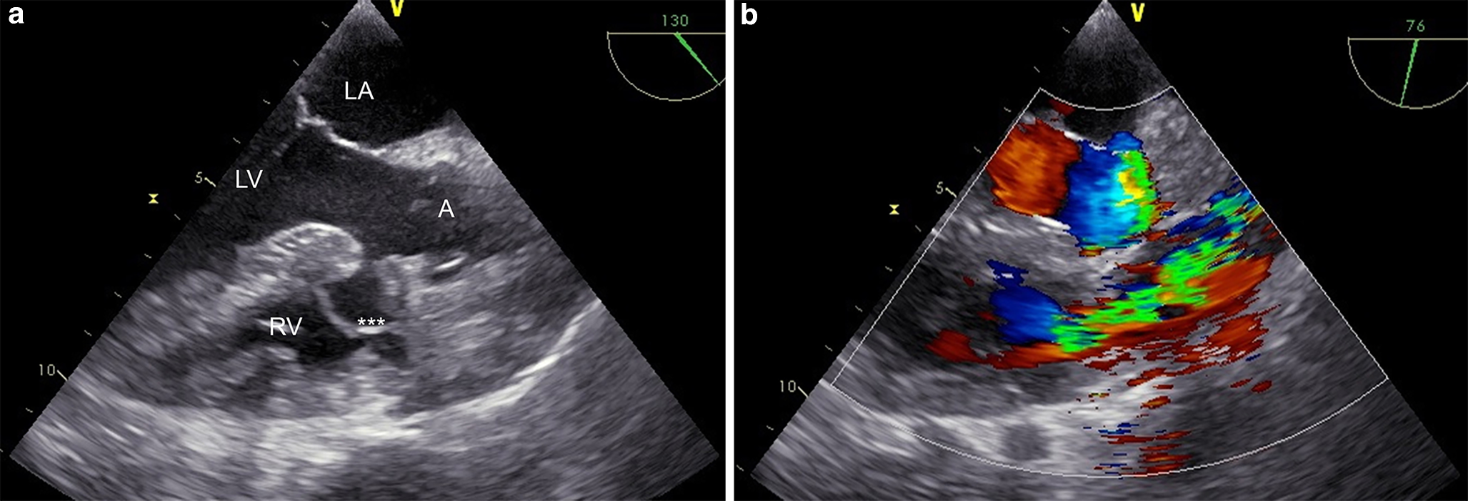 Dynamic right ventricular outflow tract obstruction caused by a large ...