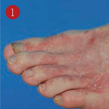 De diagnose? Tinea pedis! | SpringerLink