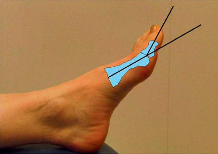 Reproduceerbaarheid dorsaal flexiemeting MTP1-gewricht | SpringerLink