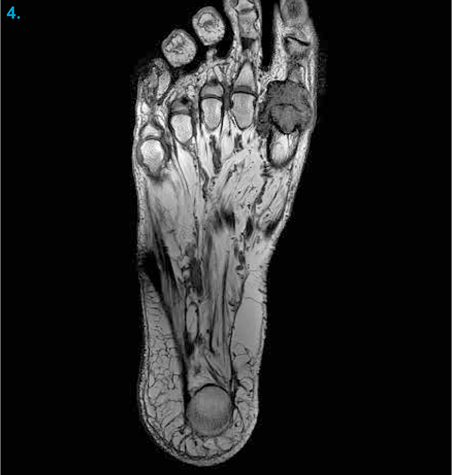 Vermoeden charcotvoet brengt tumor andere voet aan het licht | SpringerLink