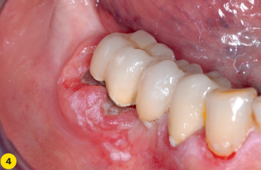 Mondkanker een overzicht | SpringerLink