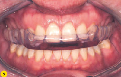 De splint | SpringerLink