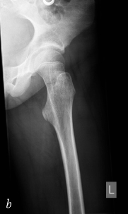 Een fractuur van het collum femoris bij een kind | SpringerLink