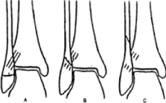 Delayed union bij ongedislokeerde weber B-fracturen | SpringerLink