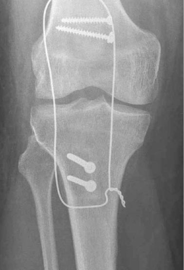 Langer bestaande ruptuur van de patellapees | SpringerLink